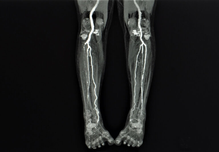 Doença Arterial Obstrutiva Periférica (DAOP) | Dr. Fernando Linares